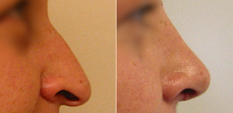 Neuscorrectie | Parkkliniek Rotterdam